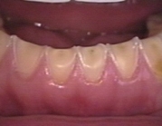 Tanderosie - tandarts.be